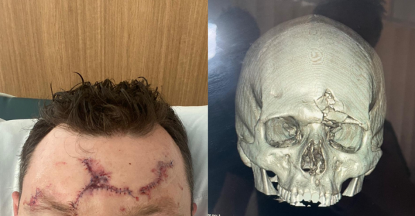 Safety Alert: Falling twistlocks during operations - ICHCA International